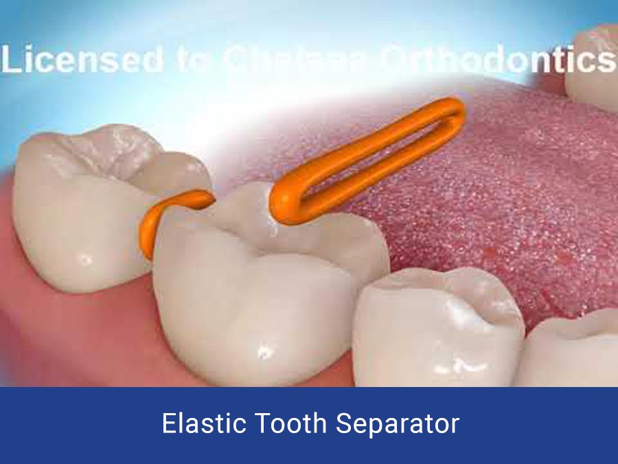 Elastic Tooth Separator | Chelsea Orthodontics
